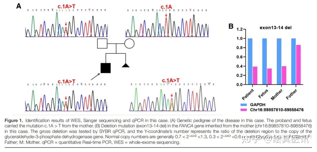 WES检出FANCA基因变异助力“误诊”为再生障碍性贫血的「范科尼贫血」患童临床诊疗 - 知乎