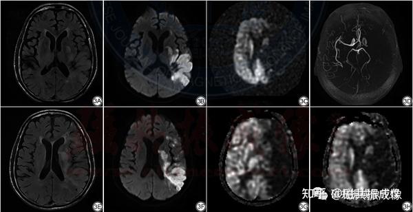 FLAIR血管高信号-弥散加权成像不匹配评估AIS侧支循环的临床价值 - 知乎