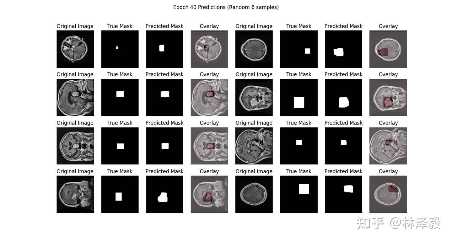 UNet脑瘤医学影像分割训练实战（PyTorch 完整代码） - 知乎