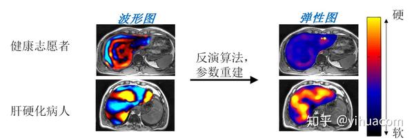 Cutting Edge-磁共振弹性成像（MRE）简介 - 知乎