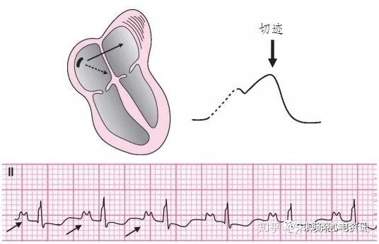 P波异常心电图口诀 - 知乎