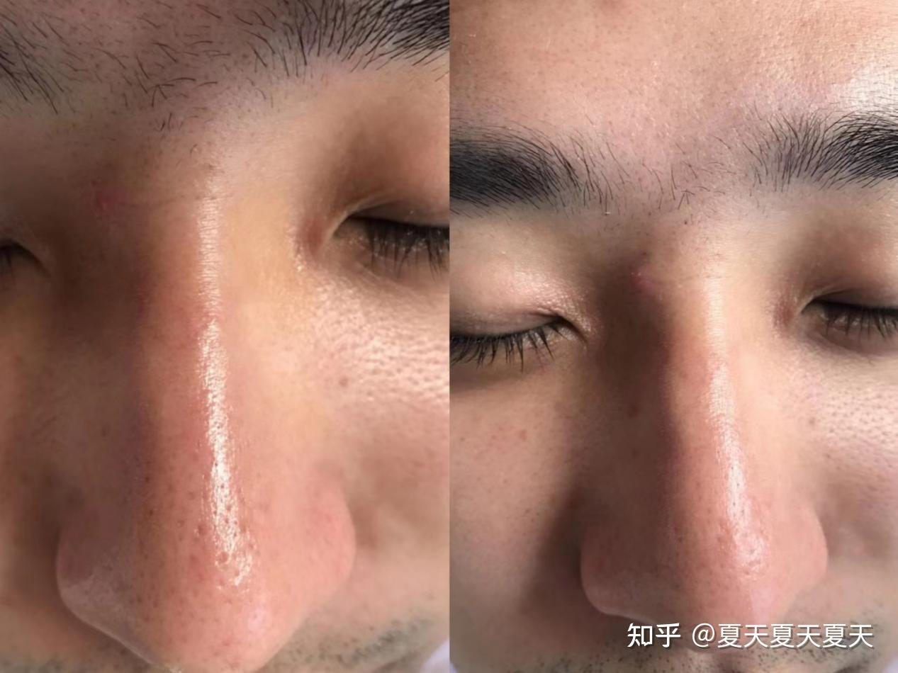站在医学角度上来说,为什么黑头总是反反复复去不干净? 知乎