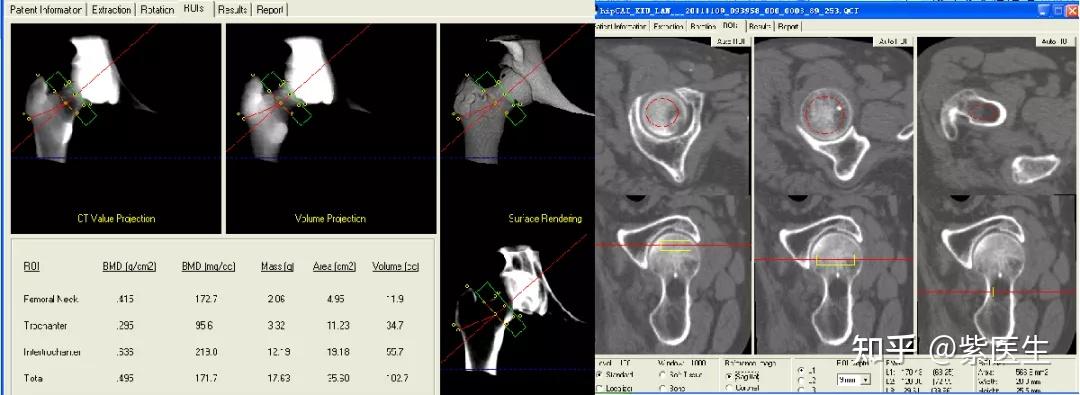 定量CT（QCT）是什么？临床应用有哪些？ - 知乎