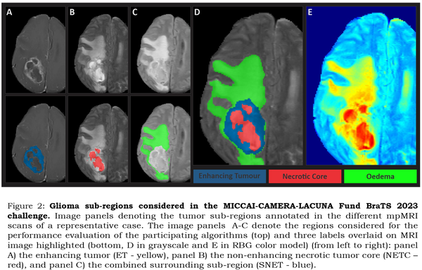 BraTS2023-SSA 数据集介绍 - 知乎