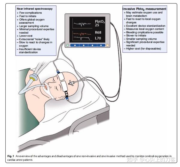 监测和改善心脏骤停后存在缺氧缺血性脑损伤风险患者的脑氧合 - 知乎
