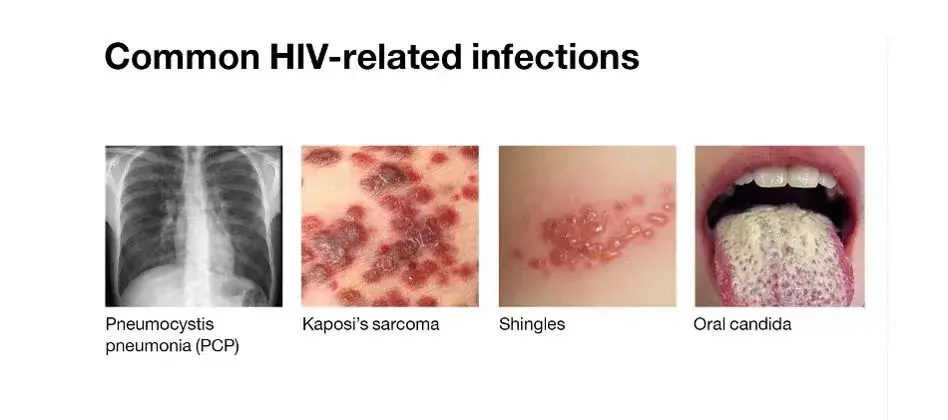 最常见的艾滋病（HIV）机会性感染？（多图） - 知乎