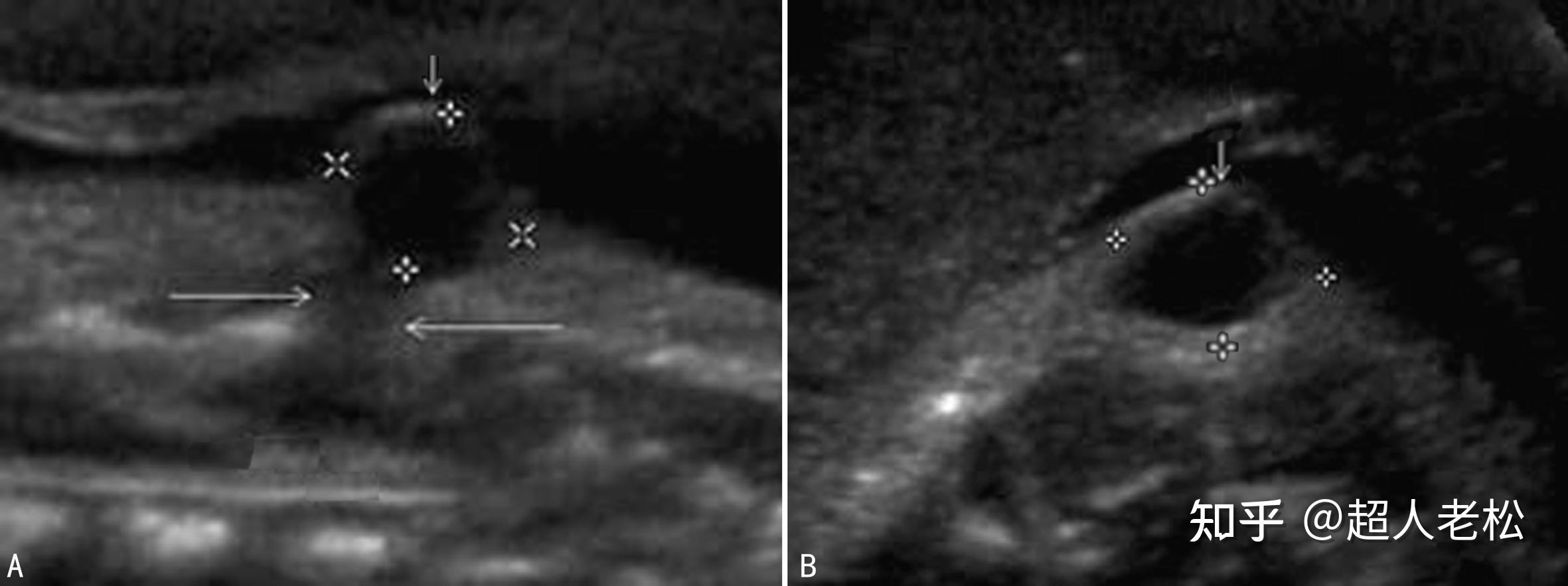 明明白白做超声25-10：胎儿神经管缺陷—脊柱裂 - 知乎