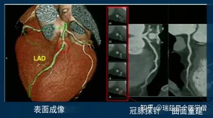 手把手教你读懂冠脉CTA - 知乎