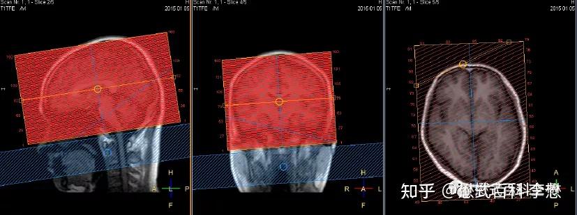 颅脑静脉MRV规范化扫描及临床应用 - 知乎