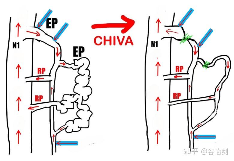 静脉曲张CHIVA治疗前后血液引流表现和动力学模式 - 知乎