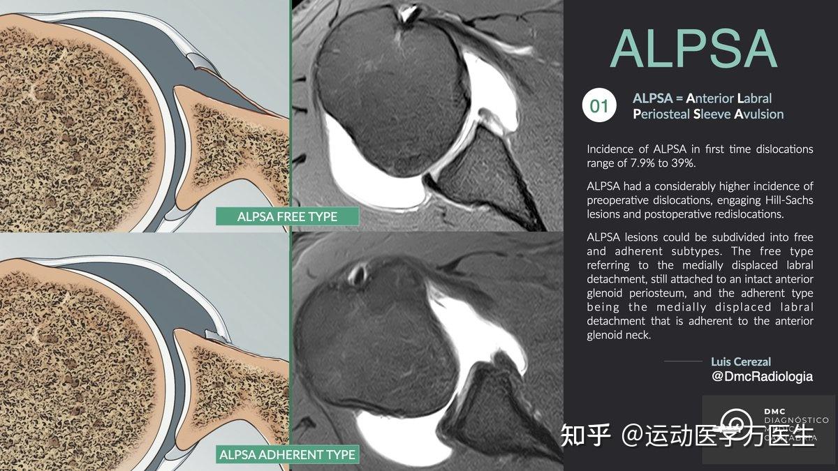 想整明白肩关节脱位、盂唇损伤，首先得先搞清楚这些相关概念 - 知乎