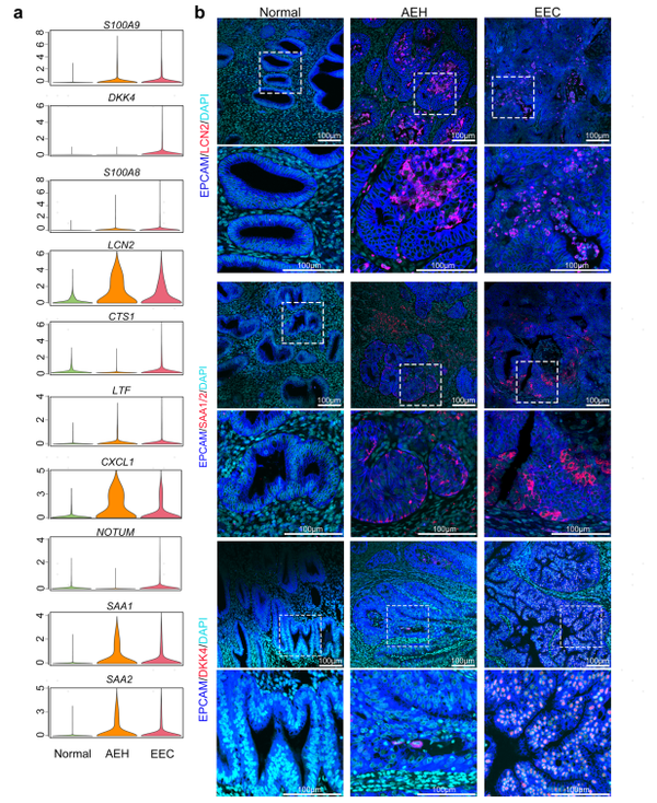 单细胞技术揭秘人子宫内膜腺癌的起源和病理过程 - 知乎