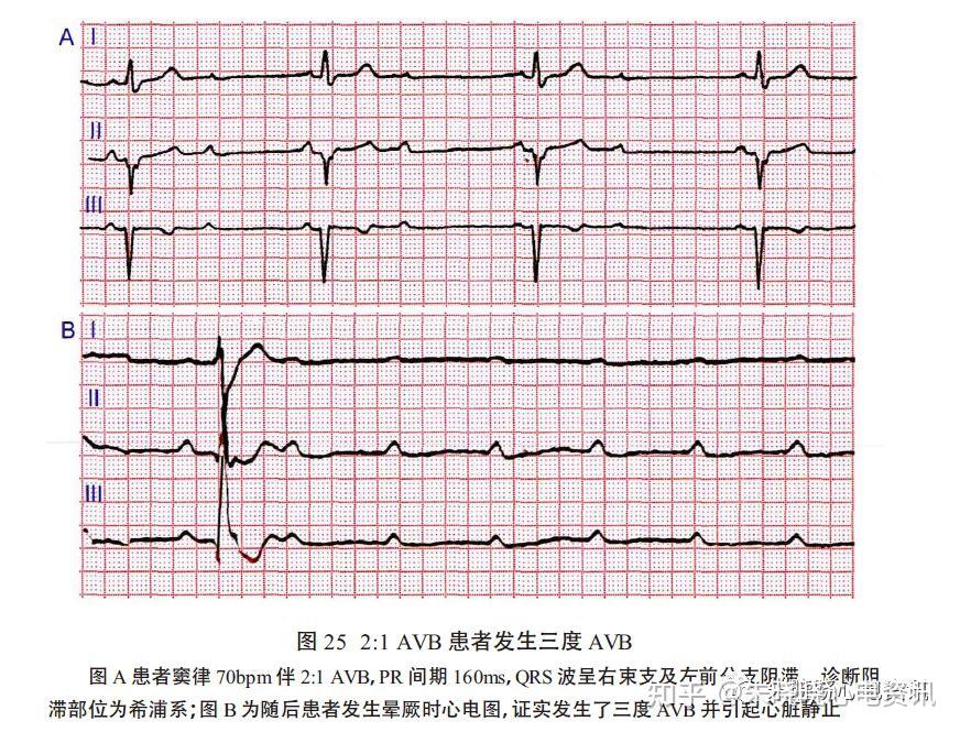 房室阻滞部位的心电图诊断 - 知乎