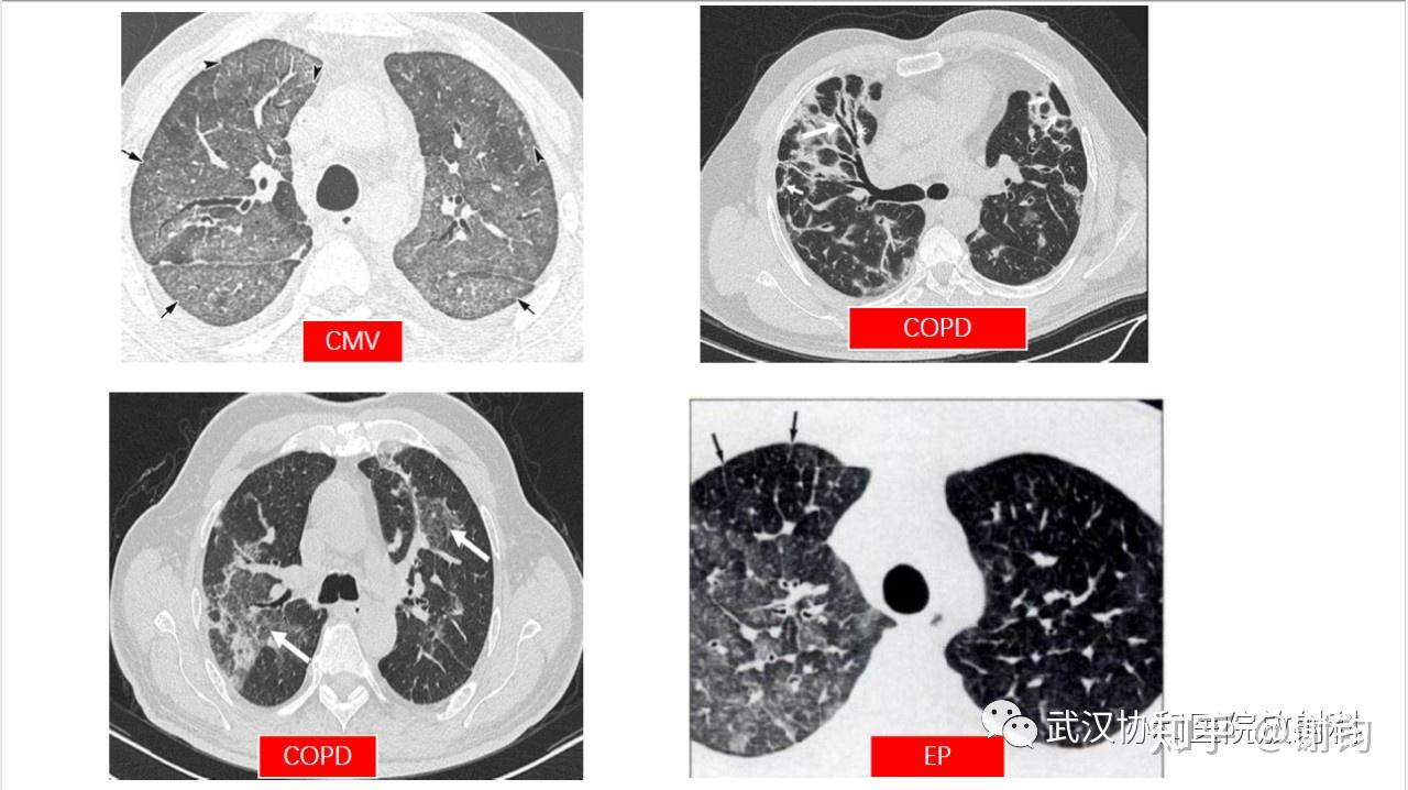 现代医学成像（3）——CT（基本原理与图像重建） - 知乎