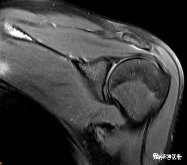 磁共振压脂技术STIR、SPIR、SPAIR还是分不清？ - 知乎