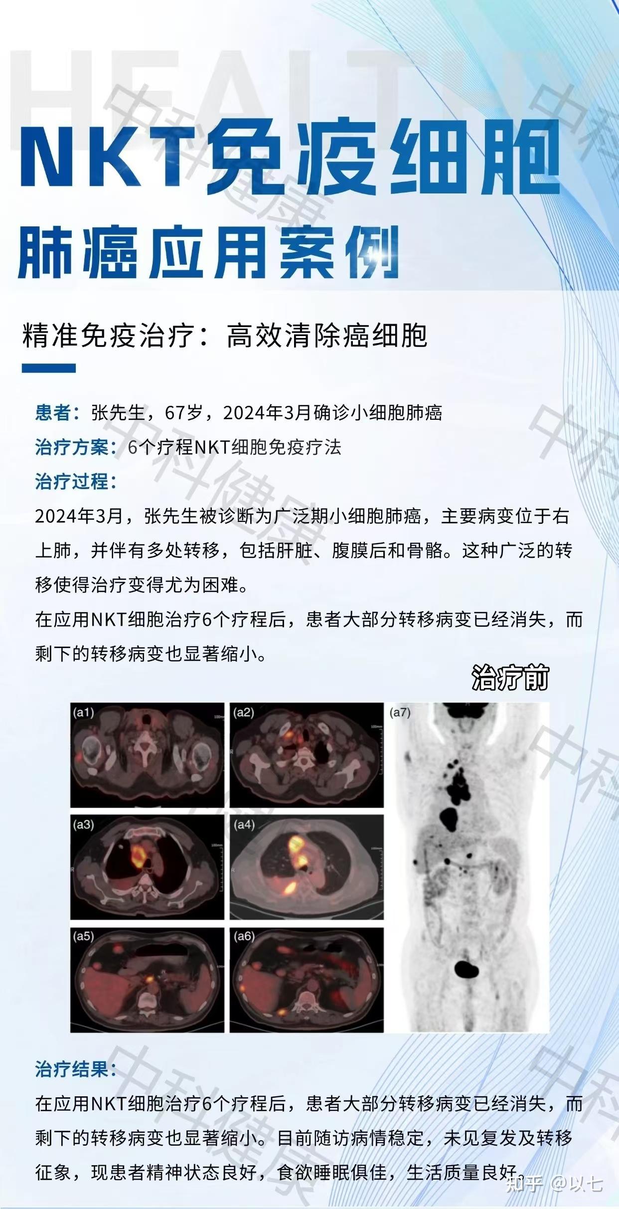 NKT细胞免疫疗法：肿瘤患者的新希望（附应用案例） - 知乎