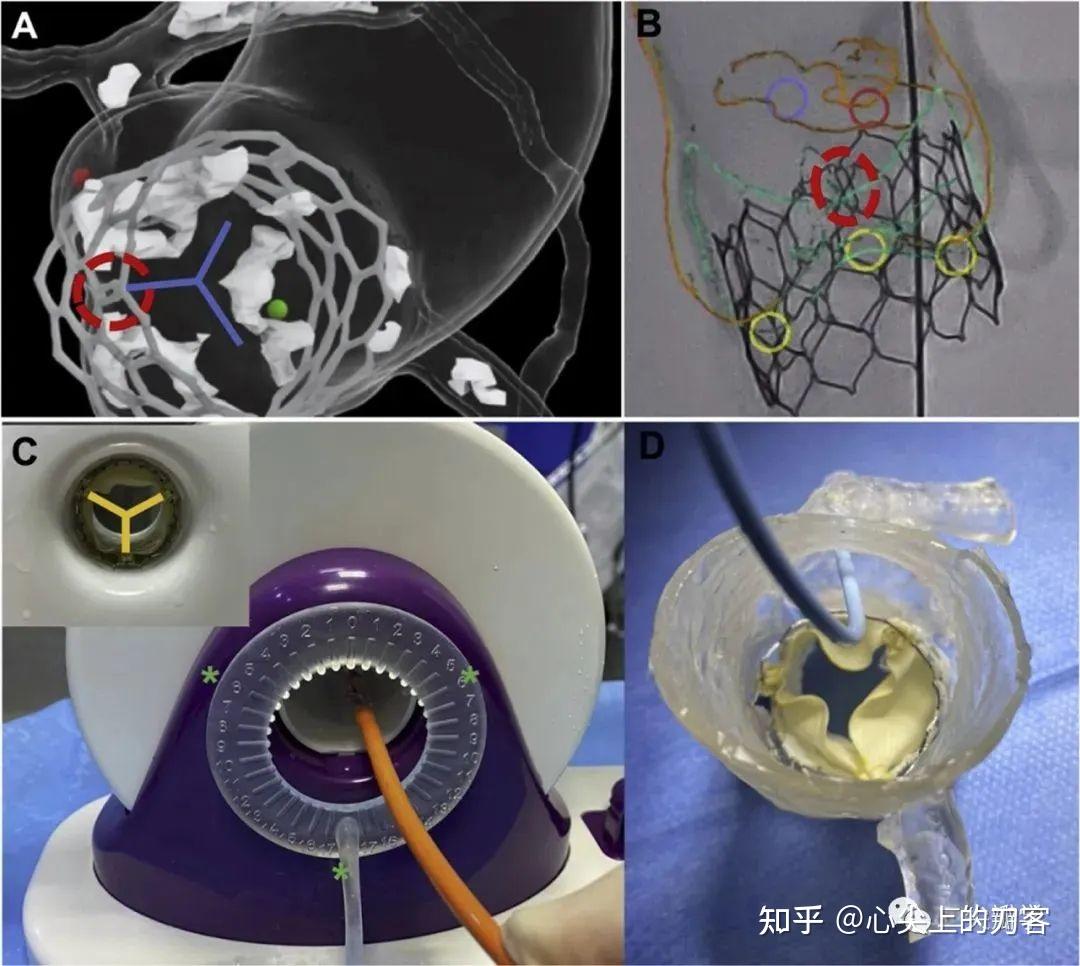 连合对齐（Commissural Alignment）：原理、定义、技术和结果（中） - 知乎