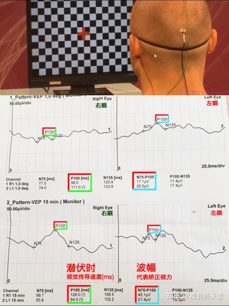 孩子弱视VEP检查，一文秒懂科普 - 知乎