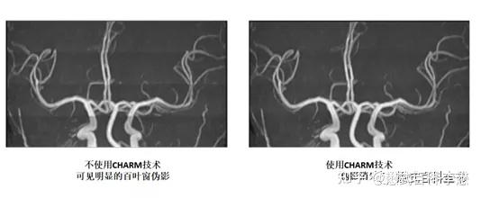 磁共振血管成像技术——流入增强TOF技术 - 知乎