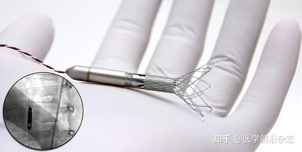 Elevate：全世界最小的介入泵，融资五千万美金 - 知乎