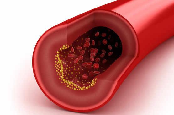 罕见遗传病新药！巴西批准Waylivra(volanesorsen)用于家族性部分脂肪营养不良 - 知乎