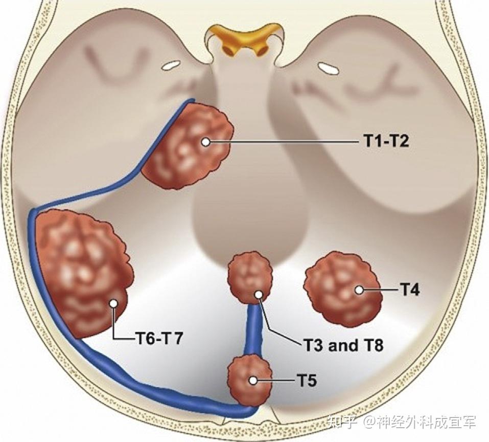 全神经内镜下切除小脑幕脑膜瘤 - 知乎