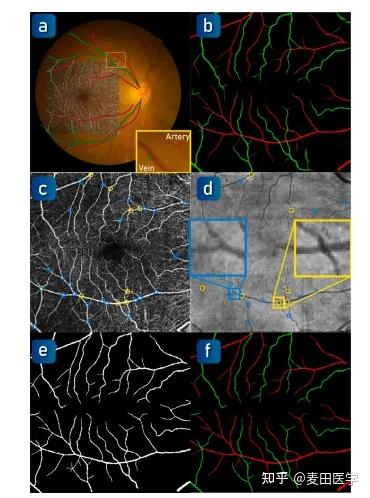 OCTA-500：用于光学相干断层扫描血管造影研究的视网膜数据集|文献速递-基于生成模型的数据增强与疾病监测应用 - 知乎