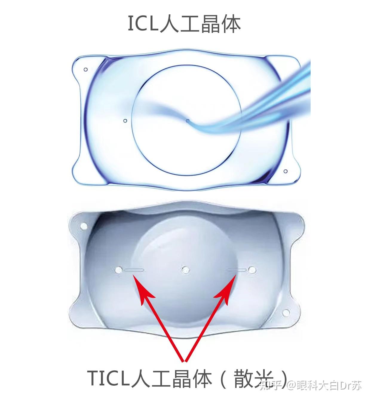 高度近视眼成功下车｜详细ICL晶体植入近视手术：术式优缺点、医生选择攻略