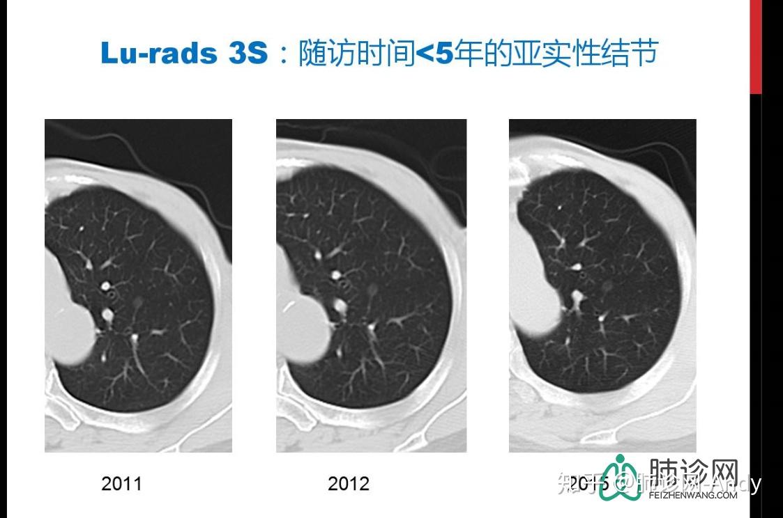 刘士远教授——肺结节lung-RADs报告分级系统解读 - 知乎