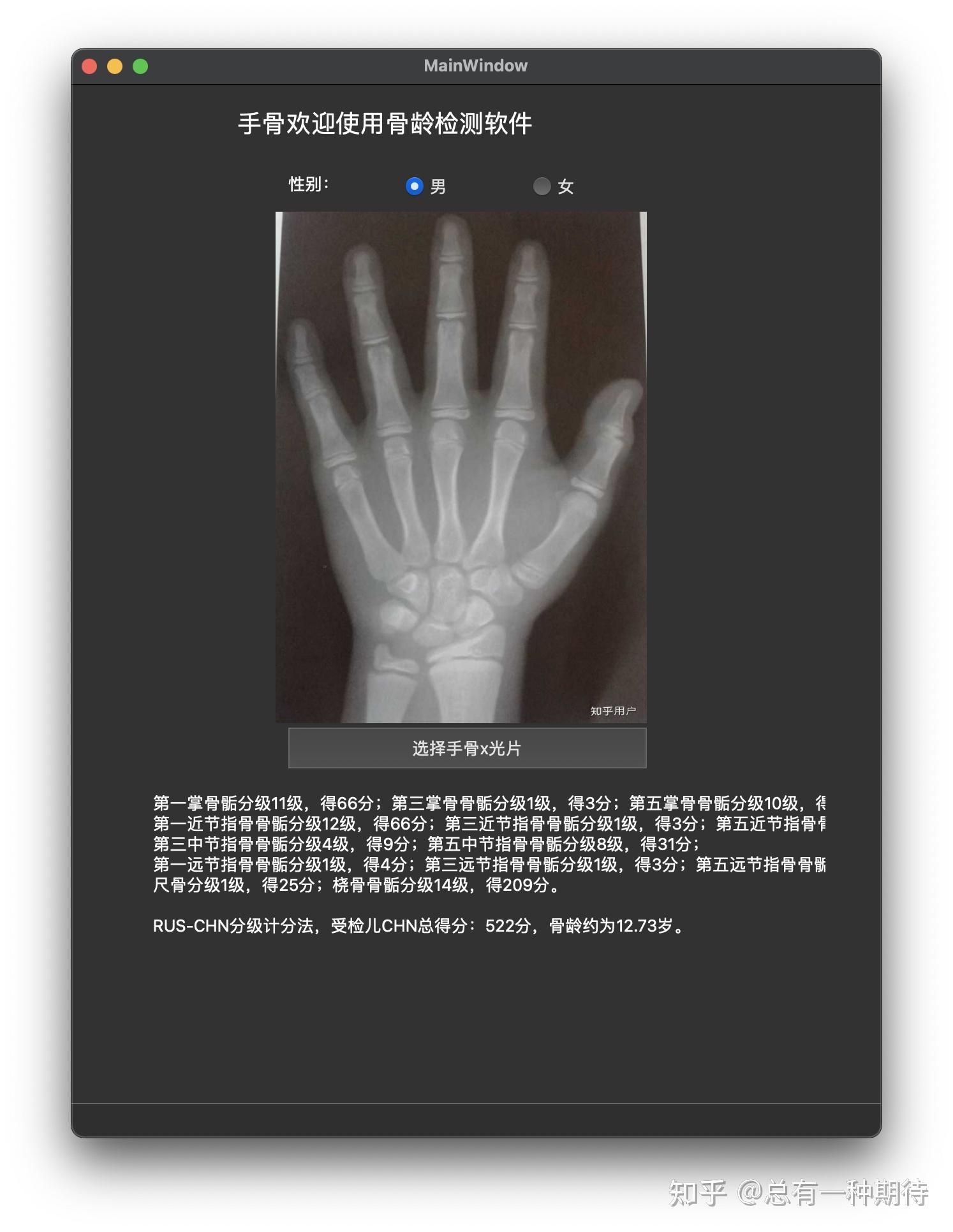 基于cnn深度学习的yolov5+pyqt+分类+resnet+骨龄检测系统 - 知乎