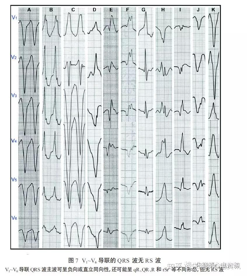 宽QRS波心动过速的鉴别诊断 - 知乎