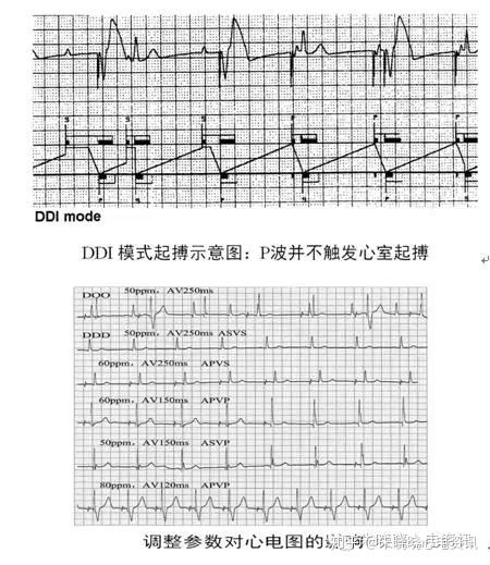 心脏起搏心电图-概念与基础 - 知乎