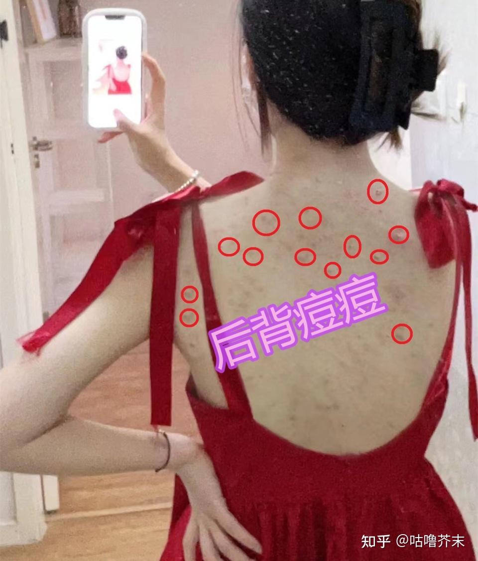 后背痘根除有奇招!过来人揭秘三步祛痘法!痘痘洗洗就能掉! 知乎