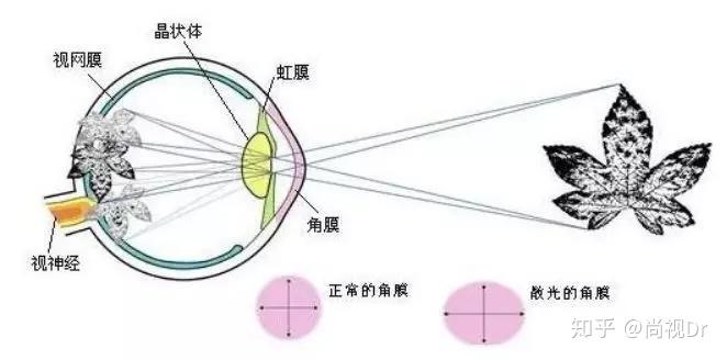 孩子散光为何会增加？ - 知乎