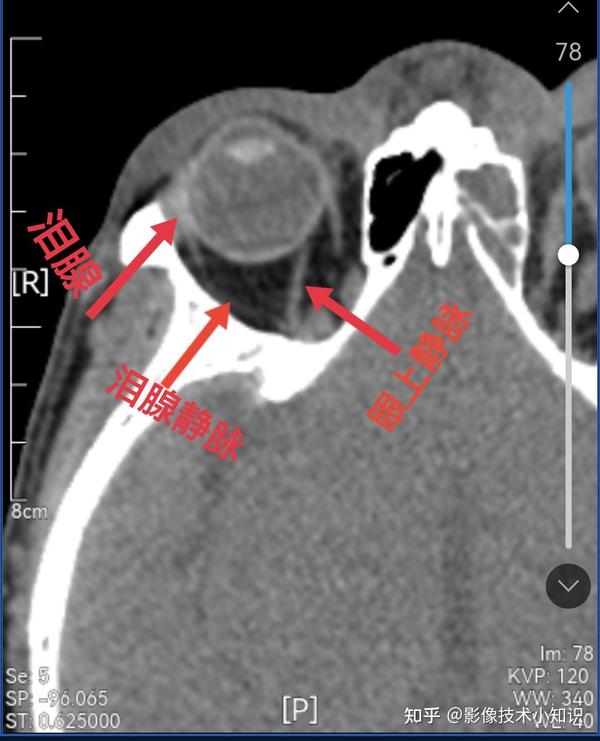 眼的CT解剖 - 知乎