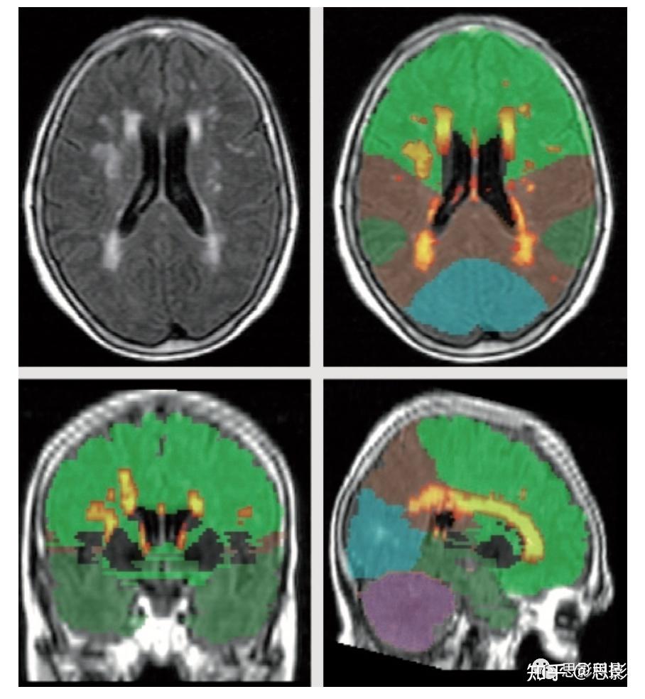 阿尔茨海默病的结构神经影像：脑白质高信号重要吗? - 知乎