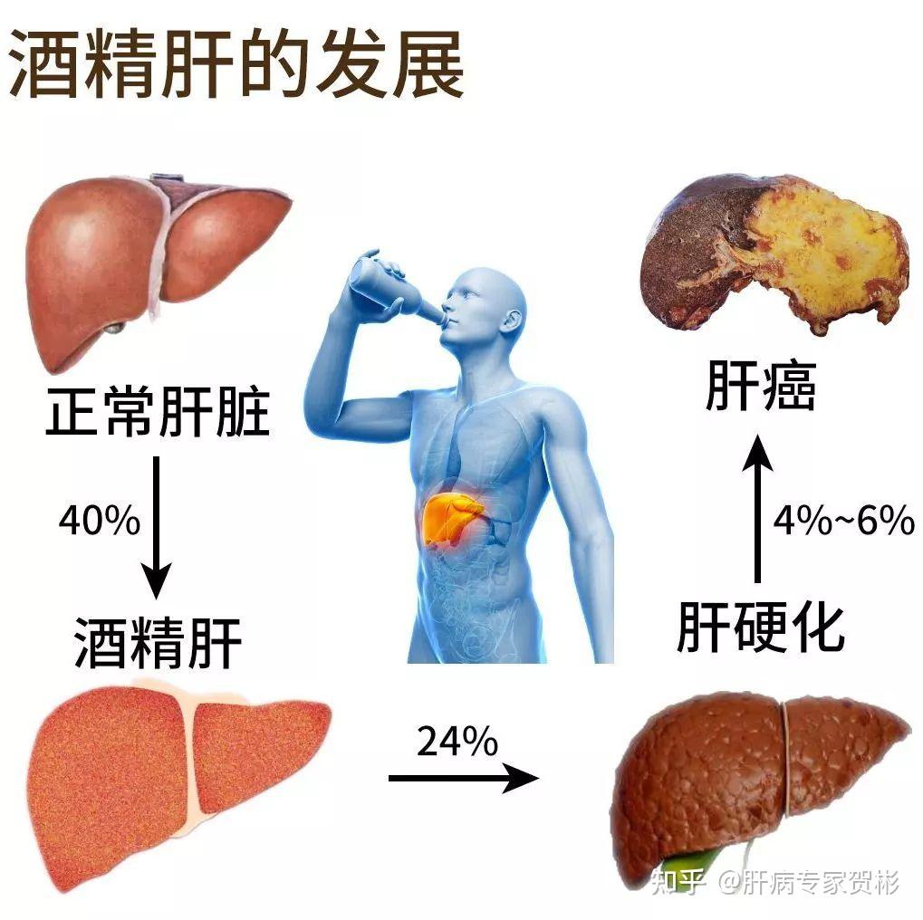 出血、腹水你还觉得酒精肝没什么吗? 知乎