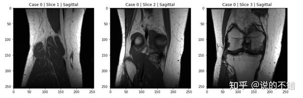MRNet数据集 - 知乎