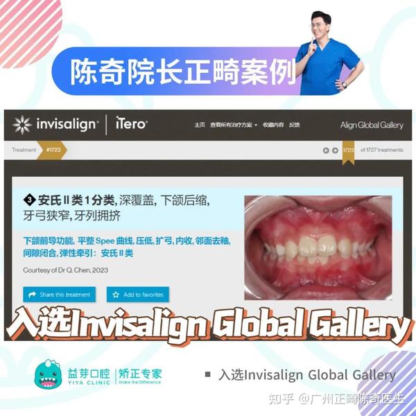 入选Invisalign Global Gallery | 上颌前突+下颌后缩青少年不拔牙隐形矫正，让脸型“变小”！ - 知乎