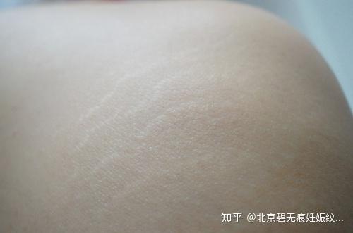 生长纹和肥胖纹的区别有哪些? 知乎