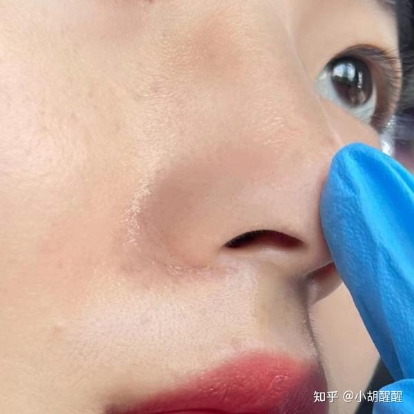 鼻子上的黑头多到都快溢出来了,如何有效的去掉黑头? 知乎