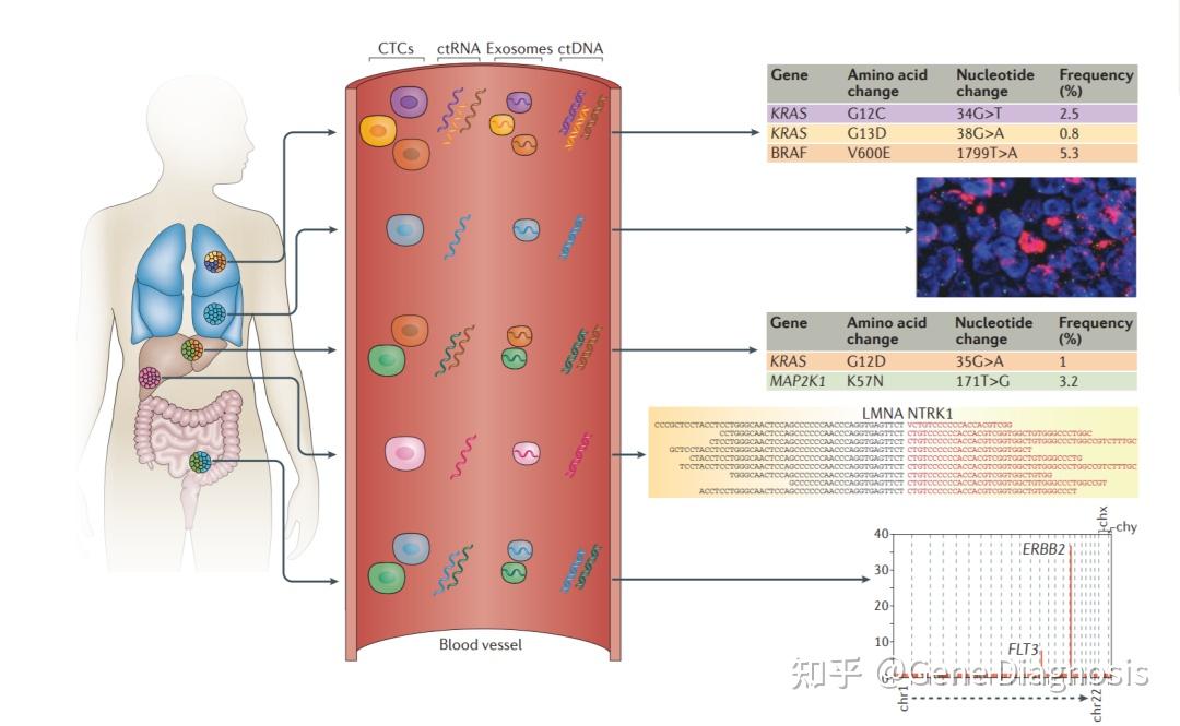 循环肿瘤细胞、循环肿瘤DNA、肿瘤细胞外囊的液体活检技术与进展 - 知乎