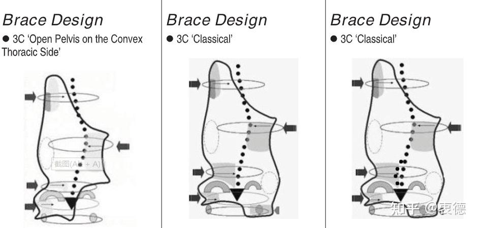 什么是“青少年特发性 脊柱侧弯”？ - 知乎