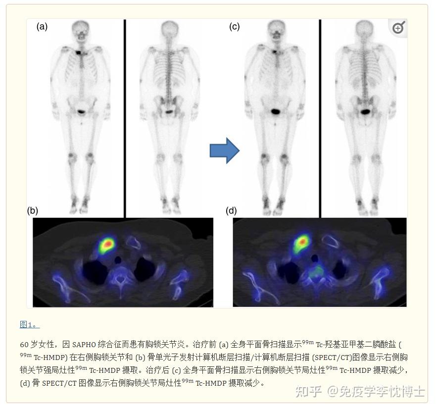 定量骨 SPECT/CT 评估胸锁关节炎患者的治疗反应！ - 知乎