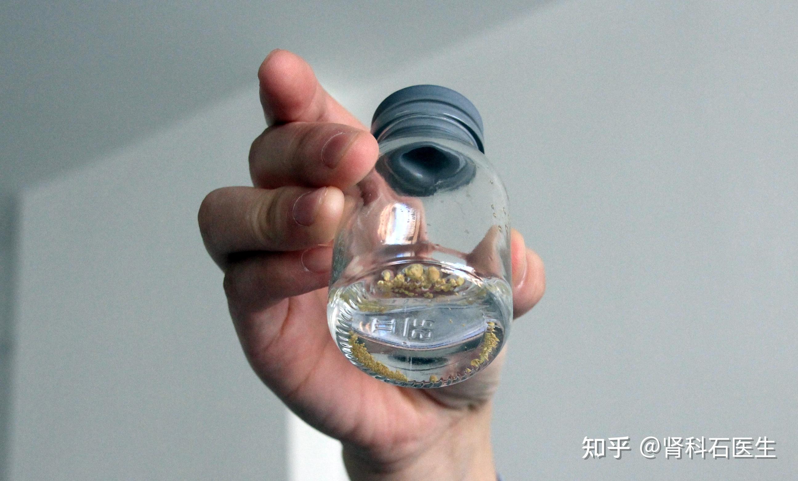 一个肾大、一个肾小：单肾萎缩还有救！结局不会太差 - 知乎