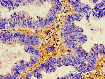 DSG2：桥粒芯蛋白家族DSGs表达最广泛的成员，心肌病、腺病毒和肿瘤新兴靶点？ - 知乎