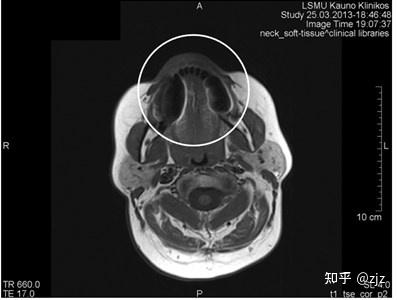 磁共振成像中的伪影：它如何真正影响诊断图像质量并混淆临床诊断？ - 知乎