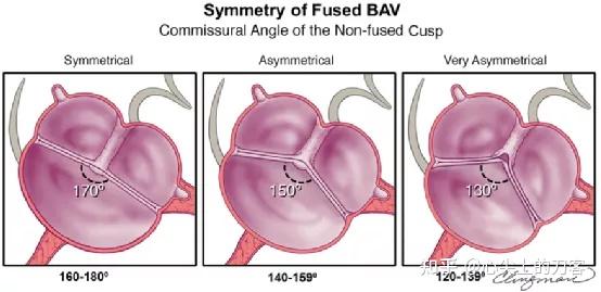 先天性二叶主动脉瓣及其主动脉病变命名和分类的国际共识声明 - 知乎