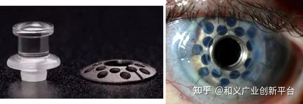 器官移植2——人工器官替代疗法介绍 - 知乎