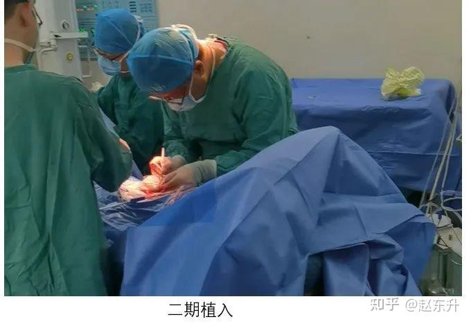 SCS脊髓电刺激疗法DTM™程控模式治疗25年右下肢顽固性疼痛 - 知乎